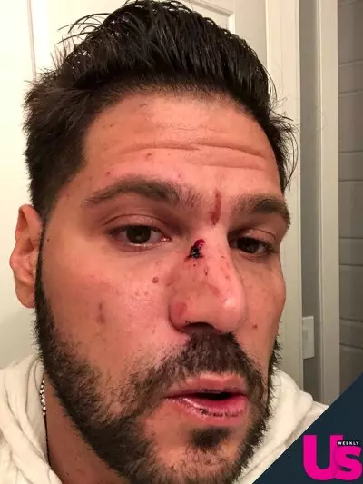 Ronnie Ortiz-Magro siger, at Jen Harley angiveligt kastede en askebæger i ansigtet og efterlod ham blodig og forslået