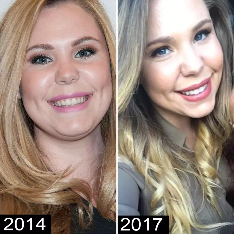 kailyn-lowry-plastik-cərrahiyyə-üz