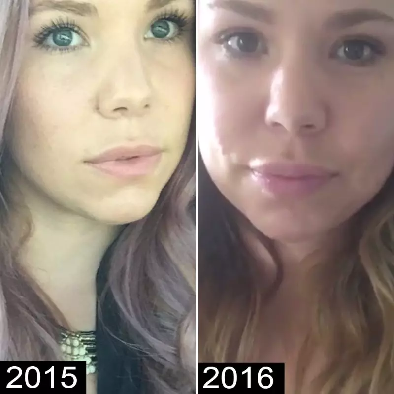 Kailyn-lowry-buze-injectii